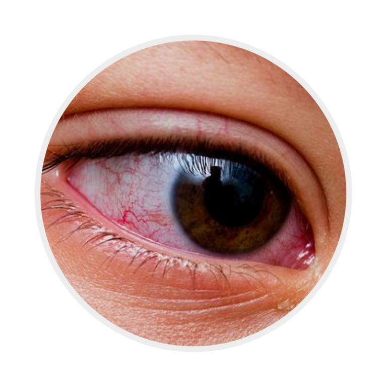KD Symptoms - Kawasaki Disease Foundation