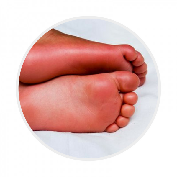 KD Symptoms - Kawasaki Disease Foundation