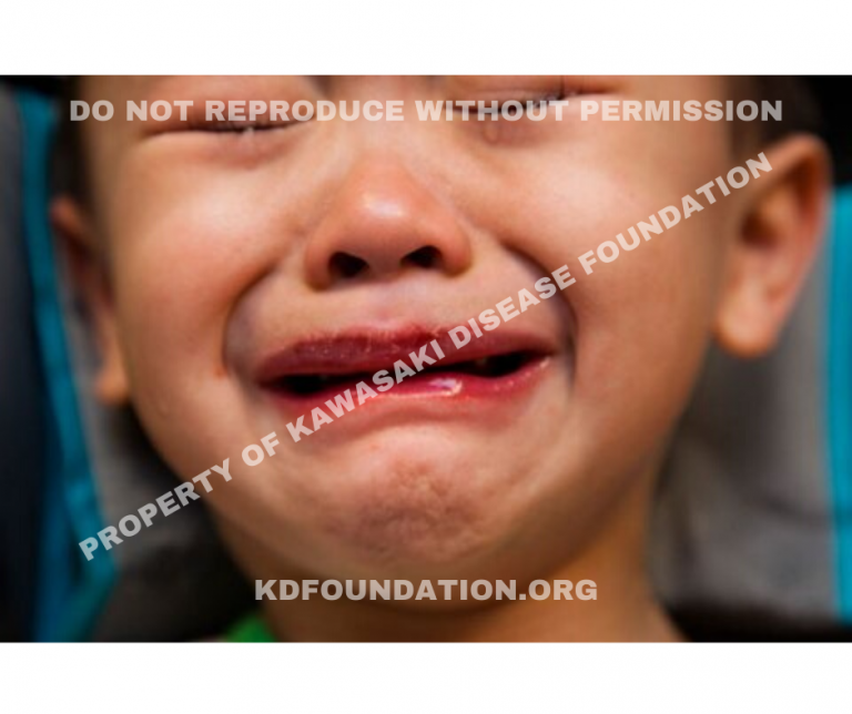 KD Symptoms Portfolio | Kawasaki Disease Foundation