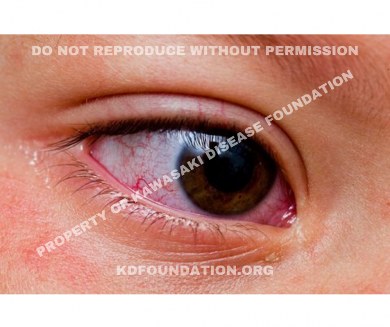KD Symptoms Portfolio | Kawasaki Disease Foundation