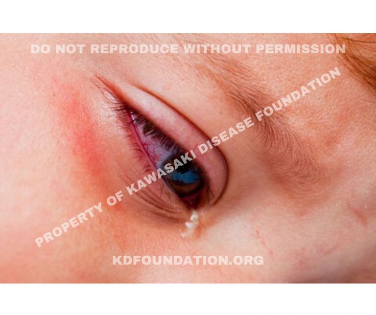 KD Symptoms Portfolio | Kawasaki Disease Foundation