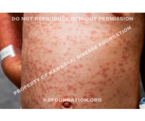 KD Symptoms Portfolio | Kawasaki Disease Foundation