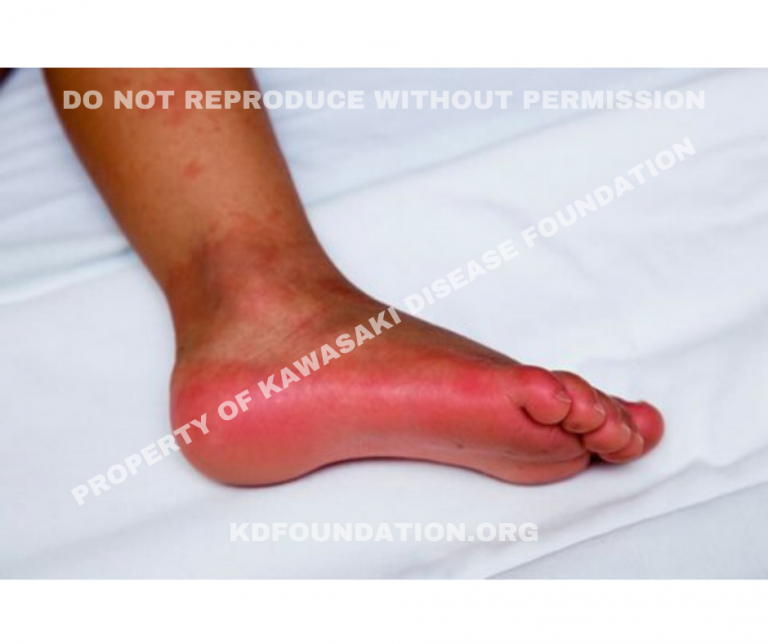KD Symptoms Portfolio | Kawasaki Disease Foundation