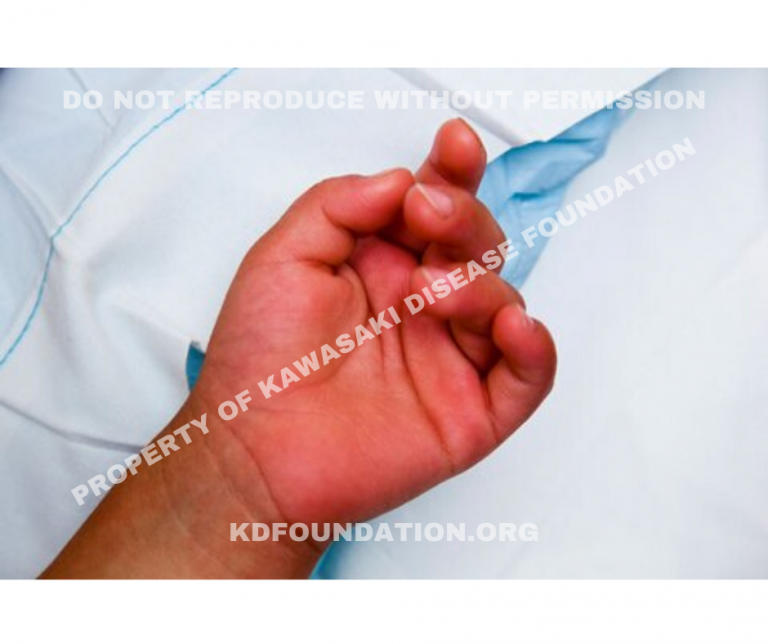KD Symptoms Portfolio | Kawasaki Disease Foundation