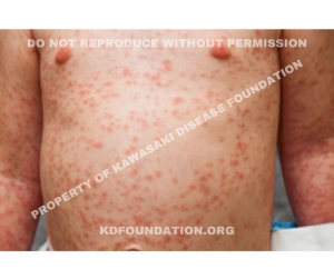 KD Symptoms Portfolio | Kawasaki Disease Foundation
