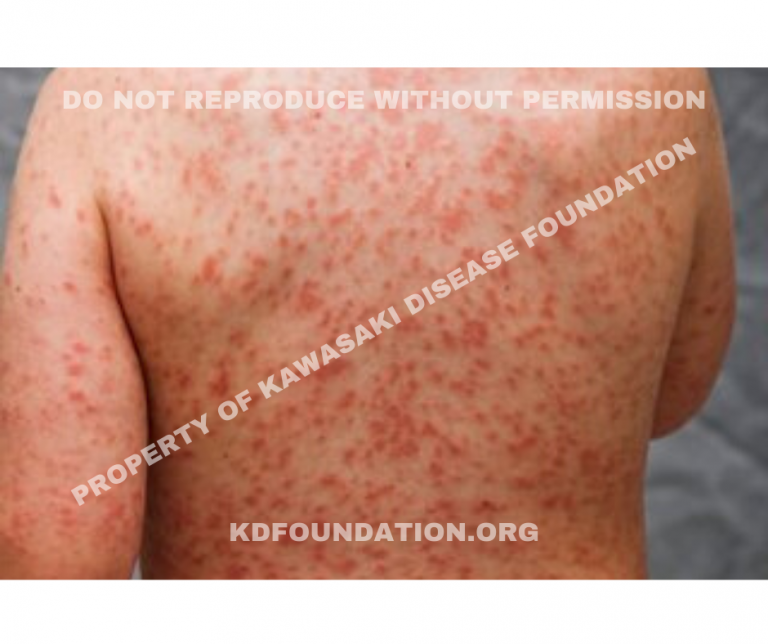 KD Symptoms Portfolio | Kawasaki Disease Foundation