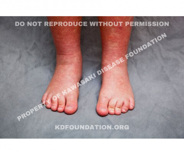 KD Symptoms Portfolio | Kawasaki Disease Foundation