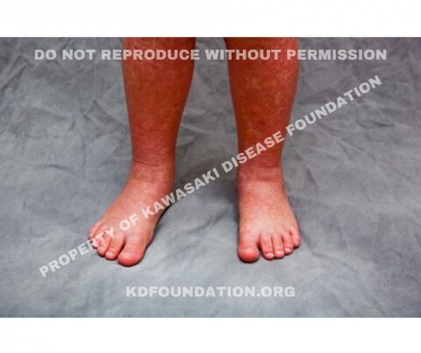 KD Symptoms Portfolio | Kawasaki Disease Foundation
