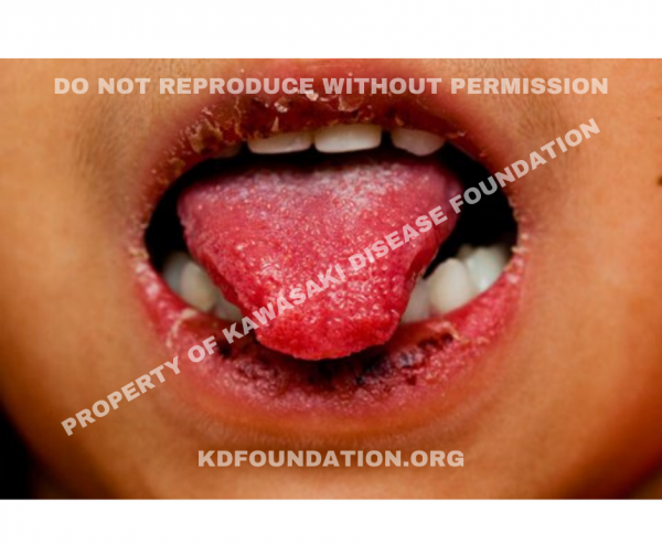 KD Symptoms Portfolio | Kawasaki Disease Foundation