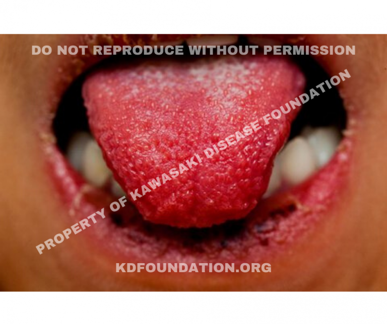 KD Symptoms Portfolio | Kawasaki Disease Foundation