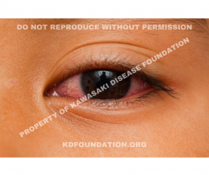 KD Symptoms Portfolio | Kawasaki Disease Foundation