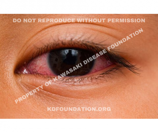 KD Symptoms Portfolio | Kawasaki Disease Foundation
