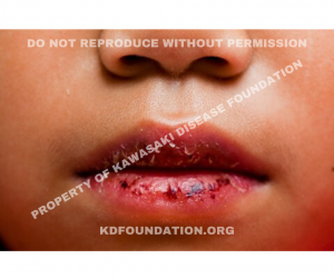 KD Symptoms Portfolio | Kawasaki Disease Foundation