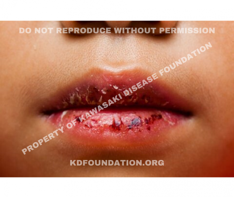 KD Symptoms Portfolio | Kawasaki Disease Foundation